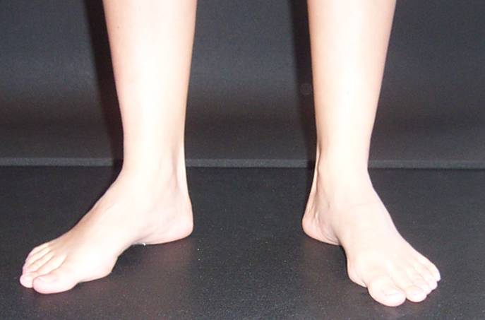 Overpronation Assessment » The BioMechanics Method